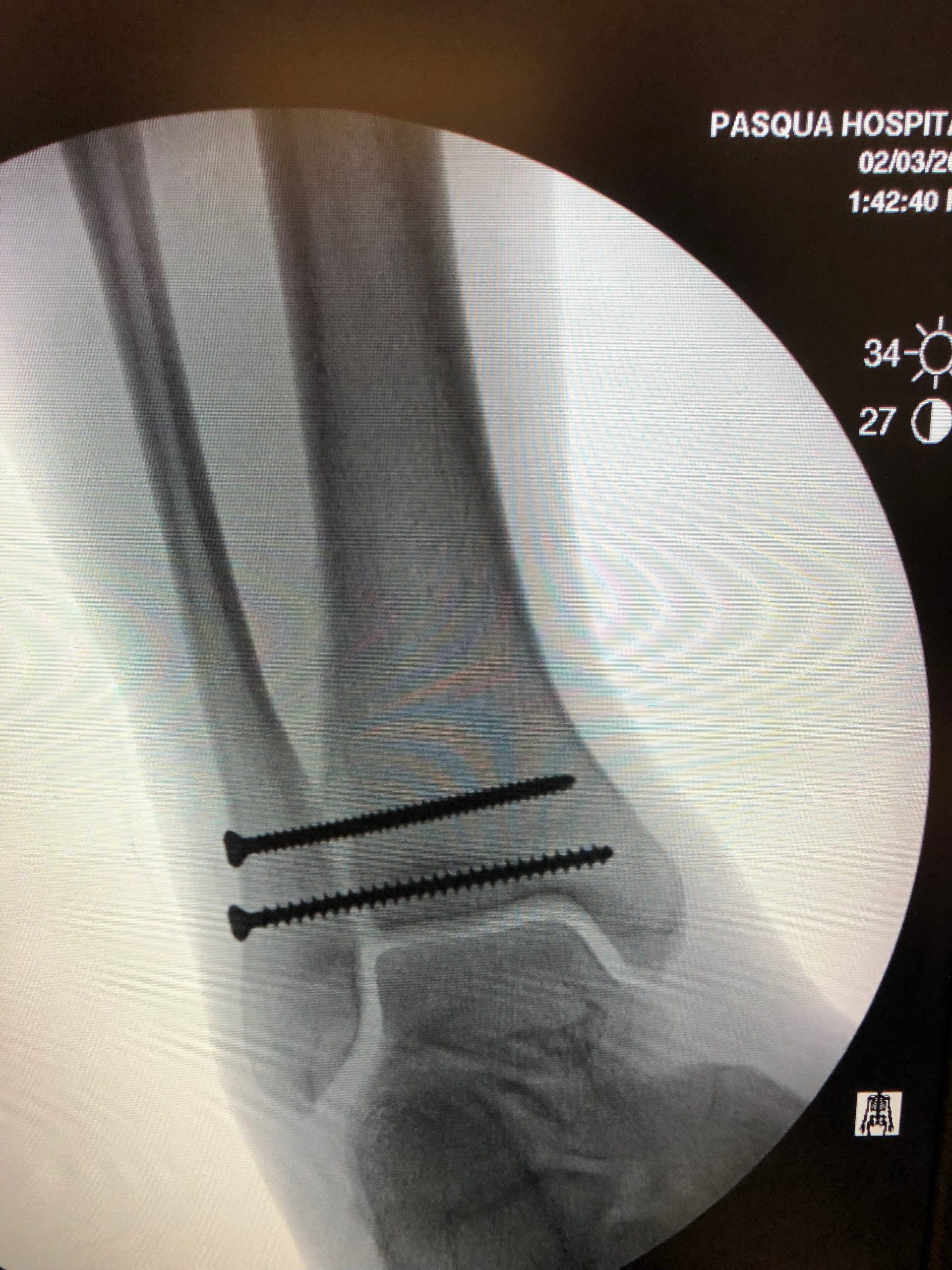 The Benefits of Breaking a Leg | Fraser Strategy Inc